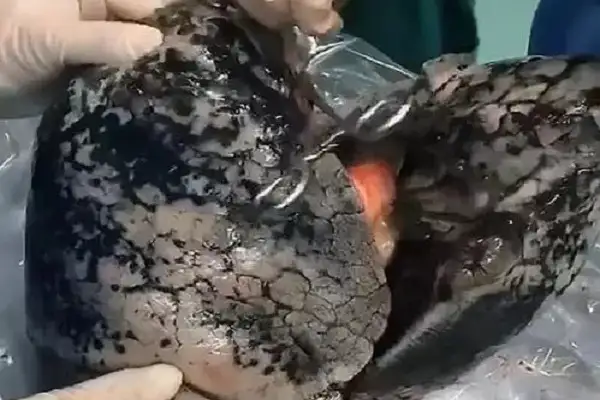 Foto Viral Paru-Paru Hitam Legam Milik Perokok Berat, Ngeri Bos! - Espos.id
